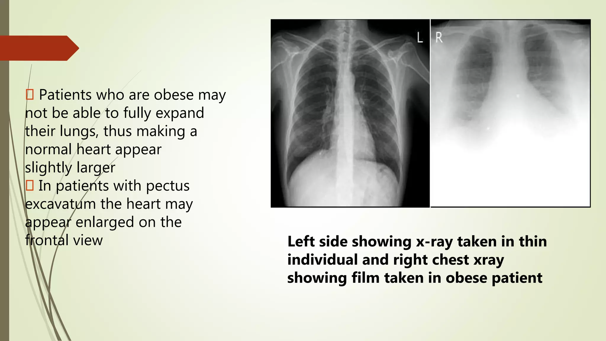 chest xray of cardiovascular disease PPT | PPTX