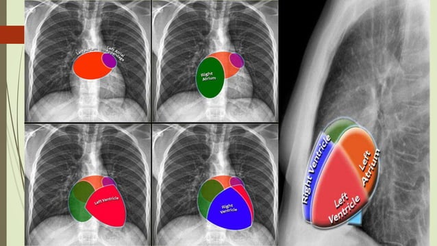 chest xray of cardiovascular disease PPT | PPTX | Heart and ...