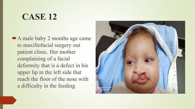GD CLEFT LIP , ORAL CANCER AND NECK SWELLINGS.pptx