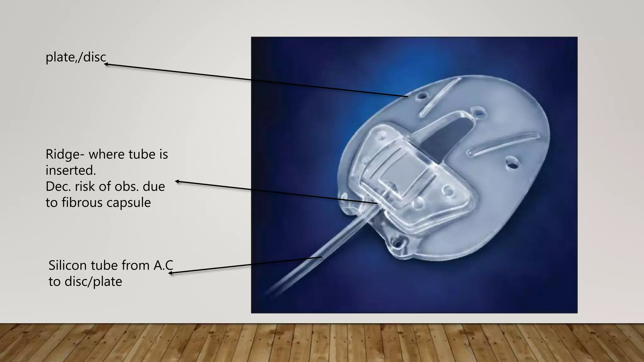 Glaucoma drainage devices | PPTX