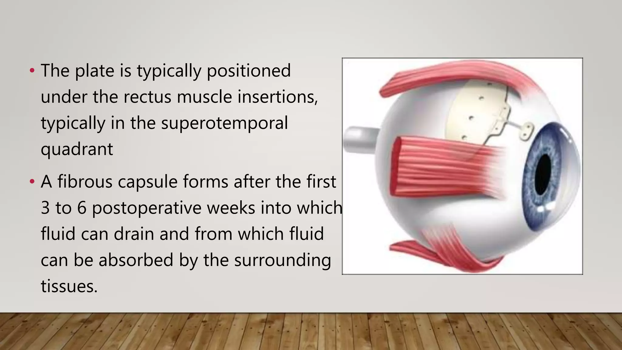 Glaucoma drainage devices | PPTX