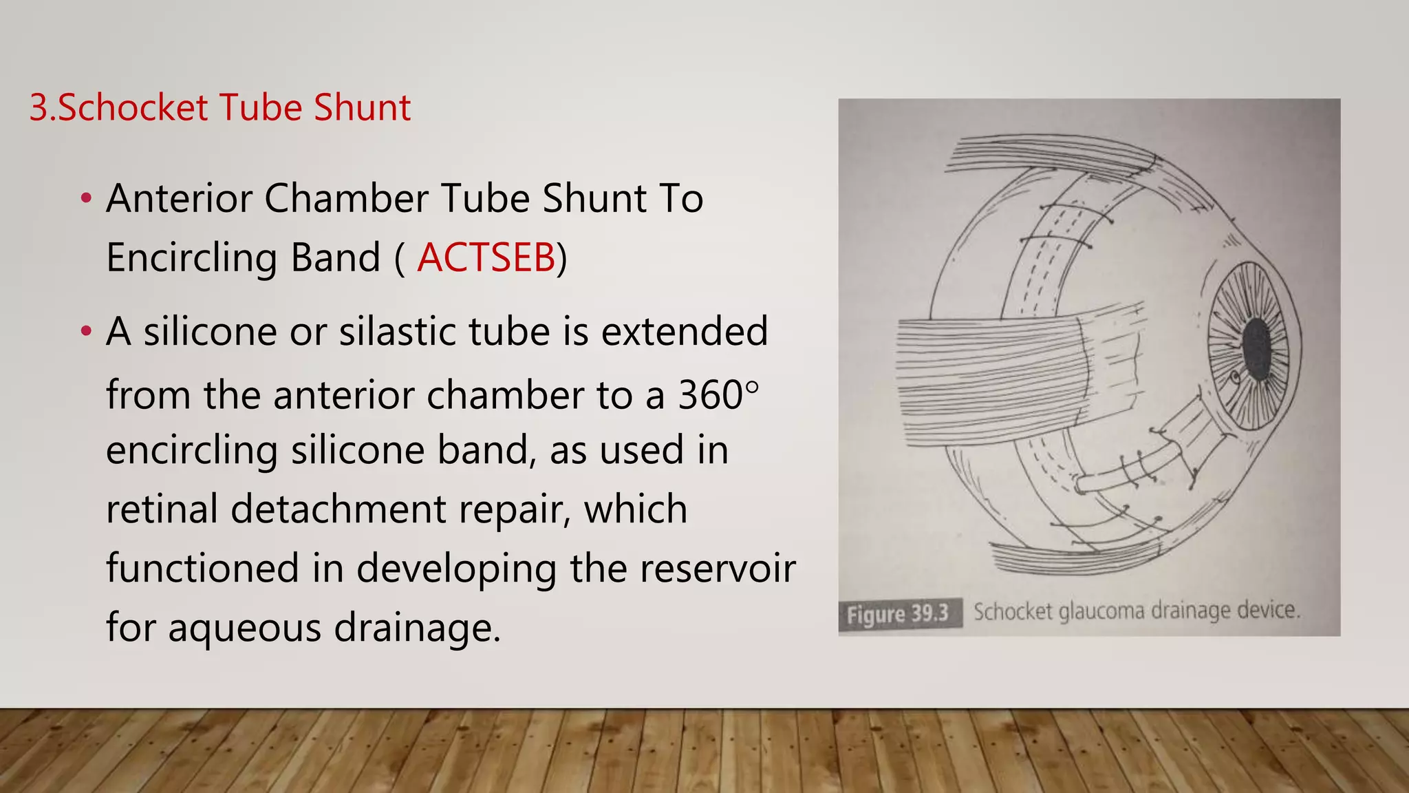 Glaucoma drainage devices | PPTX