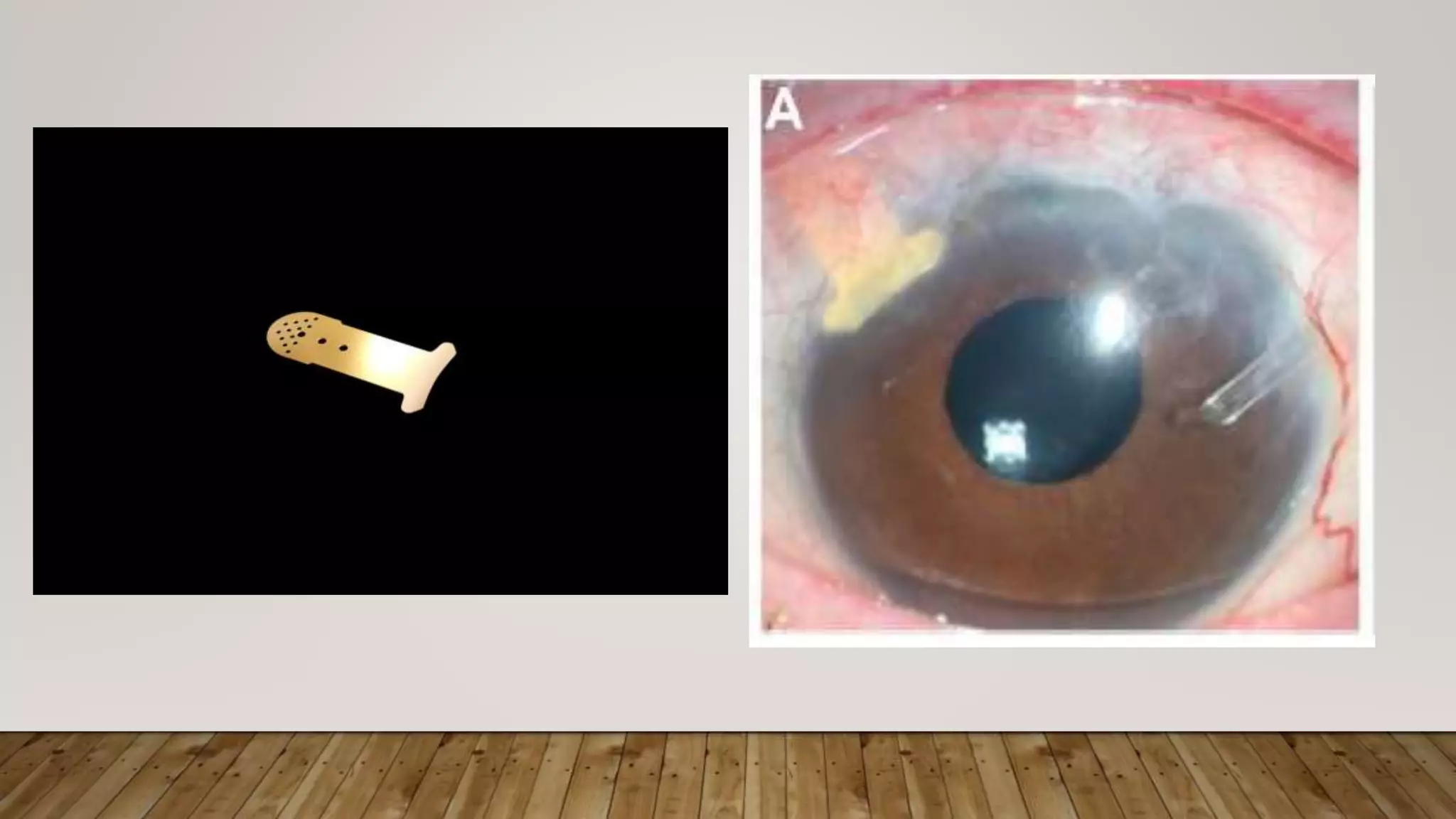 Glaucoma drainage devices | PPTX