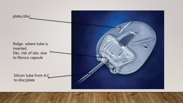 Glaucoma drainage devices | PPTX