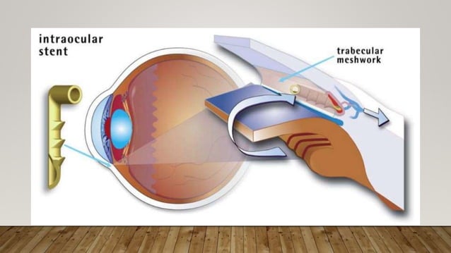 Glaucoma drainage devices | PPTX