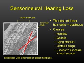 Cochlear Implants | PPT