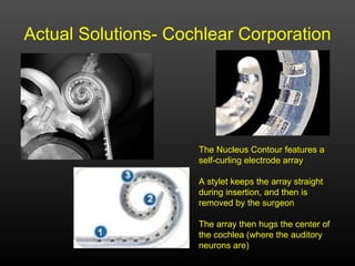 Cochlear Implants | PPT