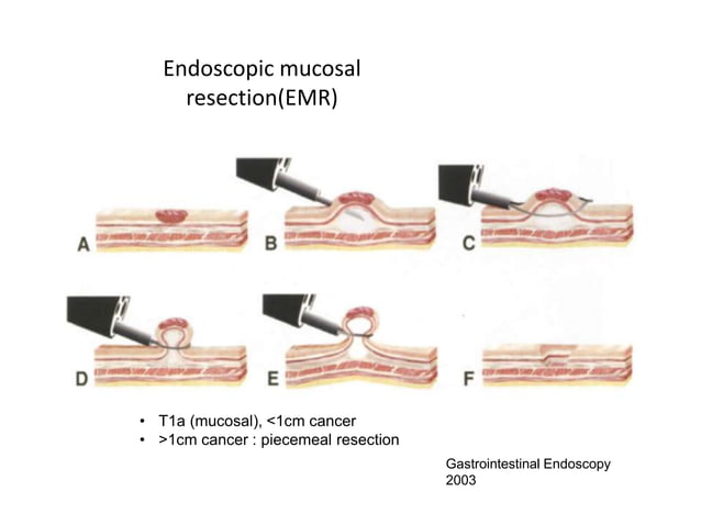 Gastroesophageal Junction Carcinoma | PPTX
