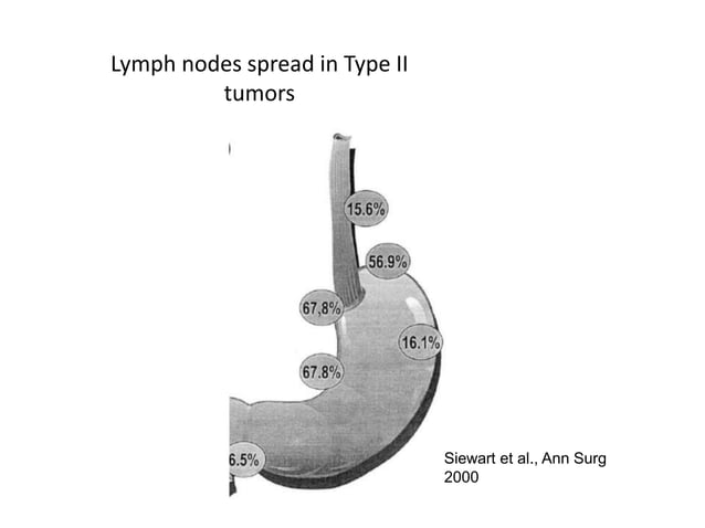 Gastroesophageal Junction Carcinoma | PPTX