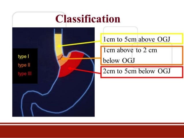 Gastroesophageal Junction Carcinoma