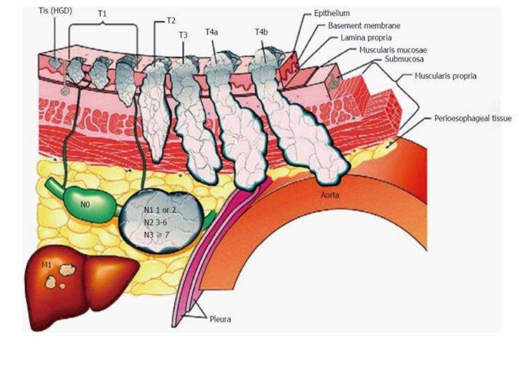 Gastroesophageal Junction Carcinoma