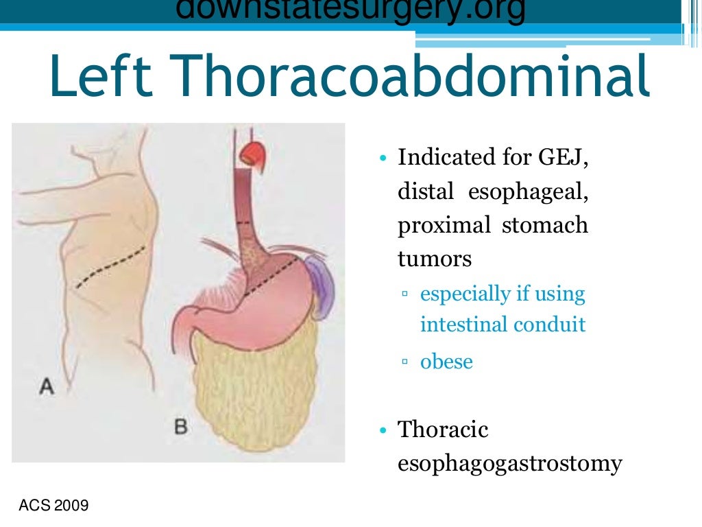 Overview of gastroesophageal junction cancers – gastroesophageal cancer ...