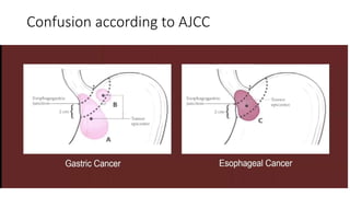 GE junction tumor-pptx | PPTX