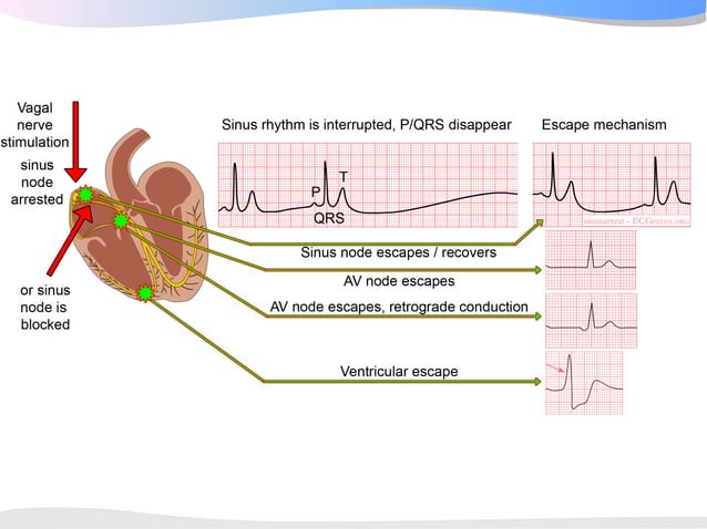 ECGpedia ECG course: conduction | PPT