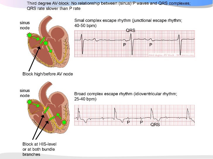 Geleidingstoornissen ECGpedia 2008