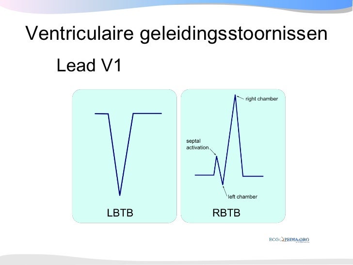 Geleidingstoornissen ECGpedia 2008