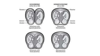 PPT EDUKASI KEHAMILAN KEMBAR ATAU GAMELI | PPT