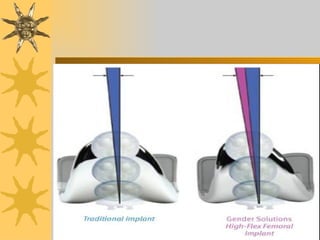 Gender Specific High Flex Knee replacement | PPT
