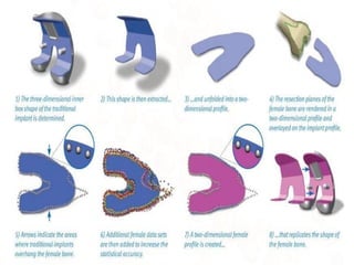 Gender Specific High Flex Knee replacement | PPT