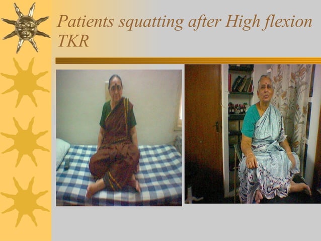 Gender Specific High Flex Knee replacement