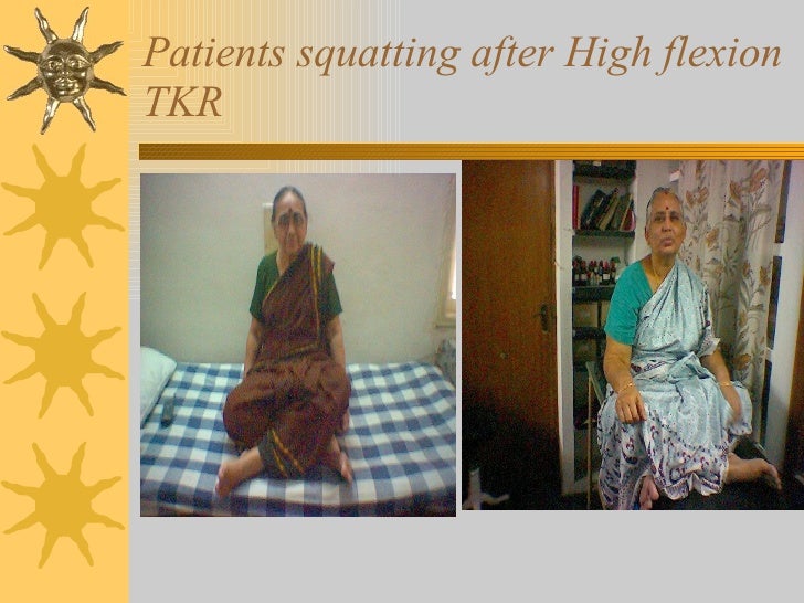 Gender Specific High Flex Knee replacement