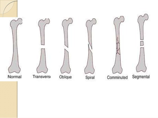 Geneal Principle of fracture