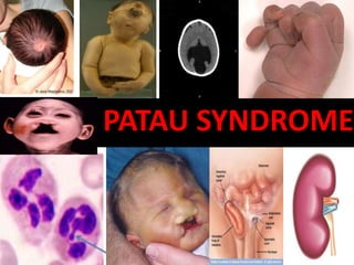 Gene disorders | PPT