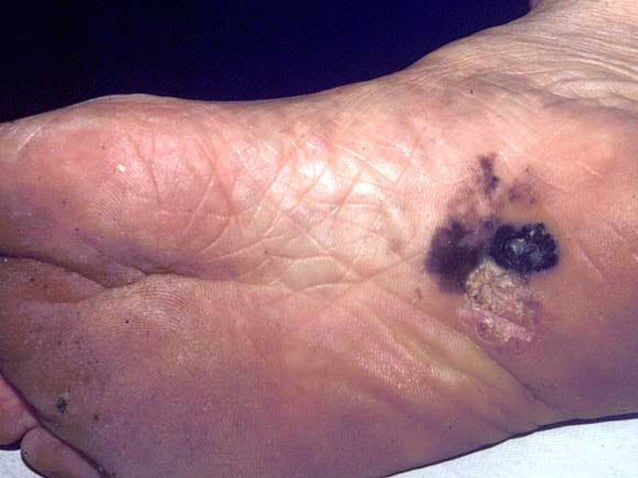 Kanser Meme Kanseri OPC | PPT