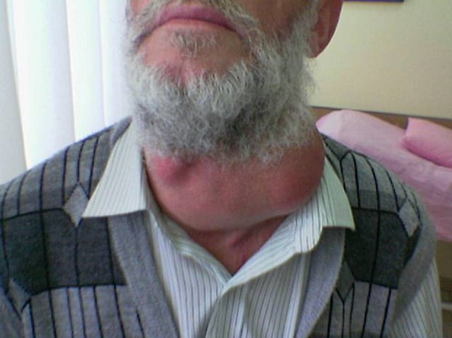 Kanser Meme Kanseri OPC | PPT