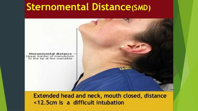 Sternomental Distance