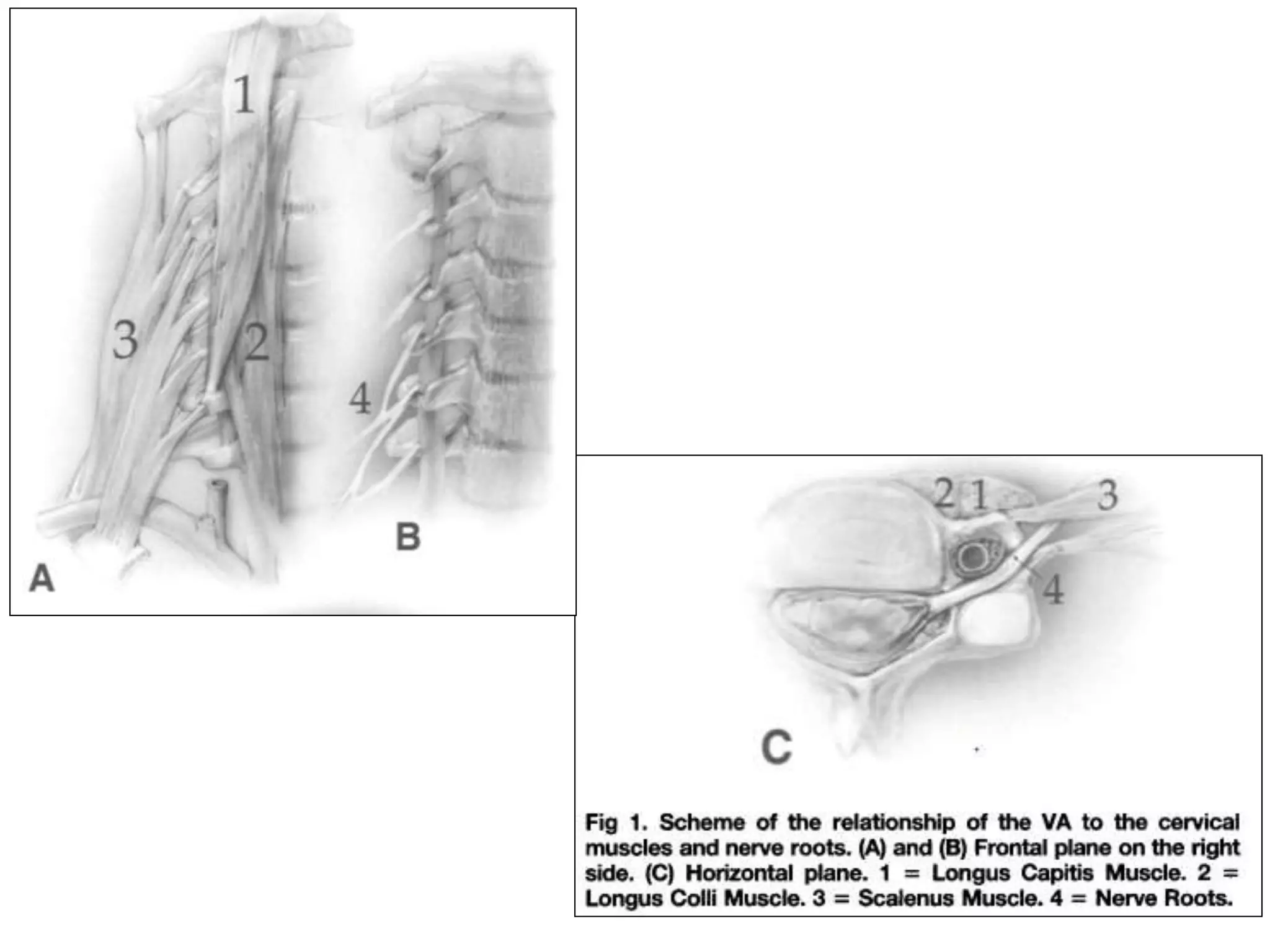 General anatomy of the vertebral artery | PPTX