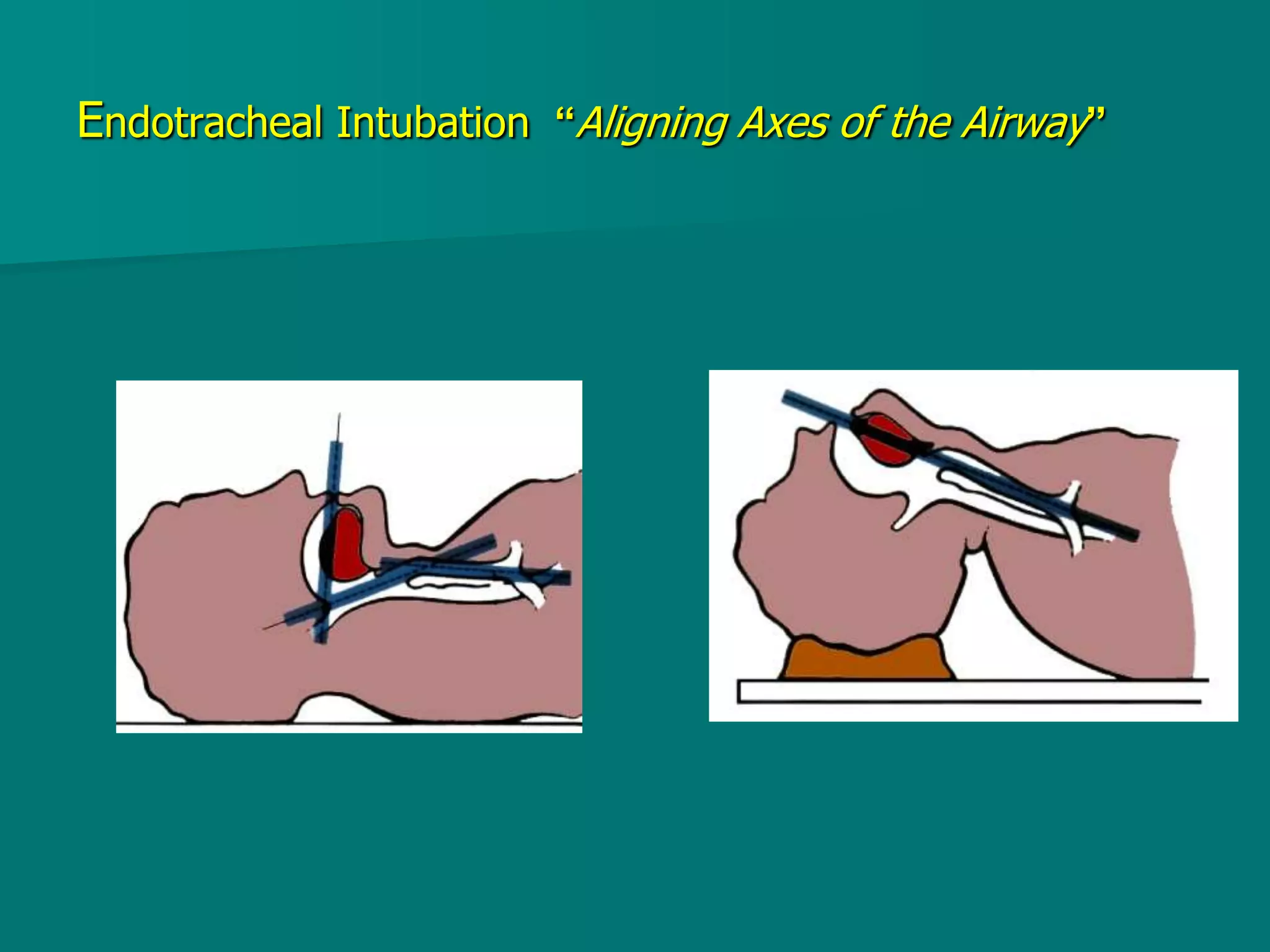 General anesthesia | PPTX