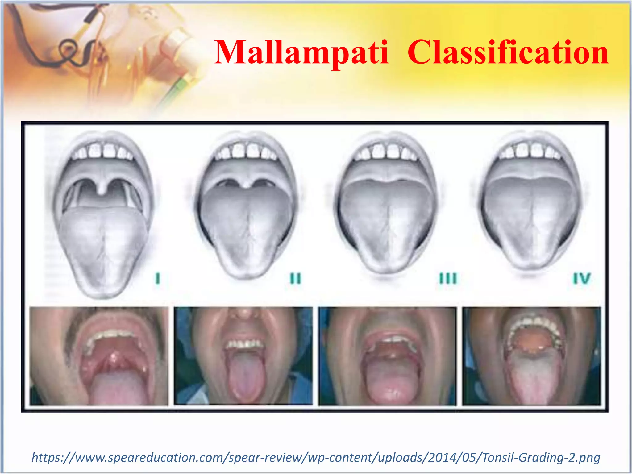 General anesthesia & oral and Maxillofacial Surgery | PPTX