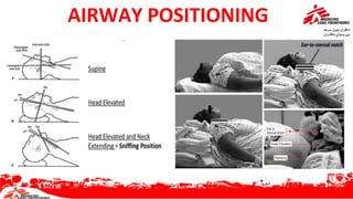 General anesthesia & obstetrics part II | PPTX