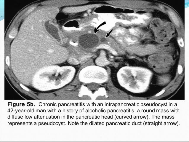 cystic pancreatic lesions
