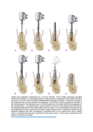 General Guidelines on Basic Dental Implant Treatment.pdf | Dental ...