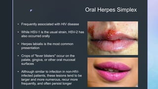 General_HIVandENT.pptx GENERAL HIV AND ENT | PPTX