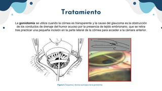 Generalidades de la enfermedad Glaucoma y otras más | PDF