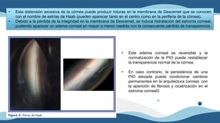 Generalidades de la enfermedad Glaucoma y otras más | PDF