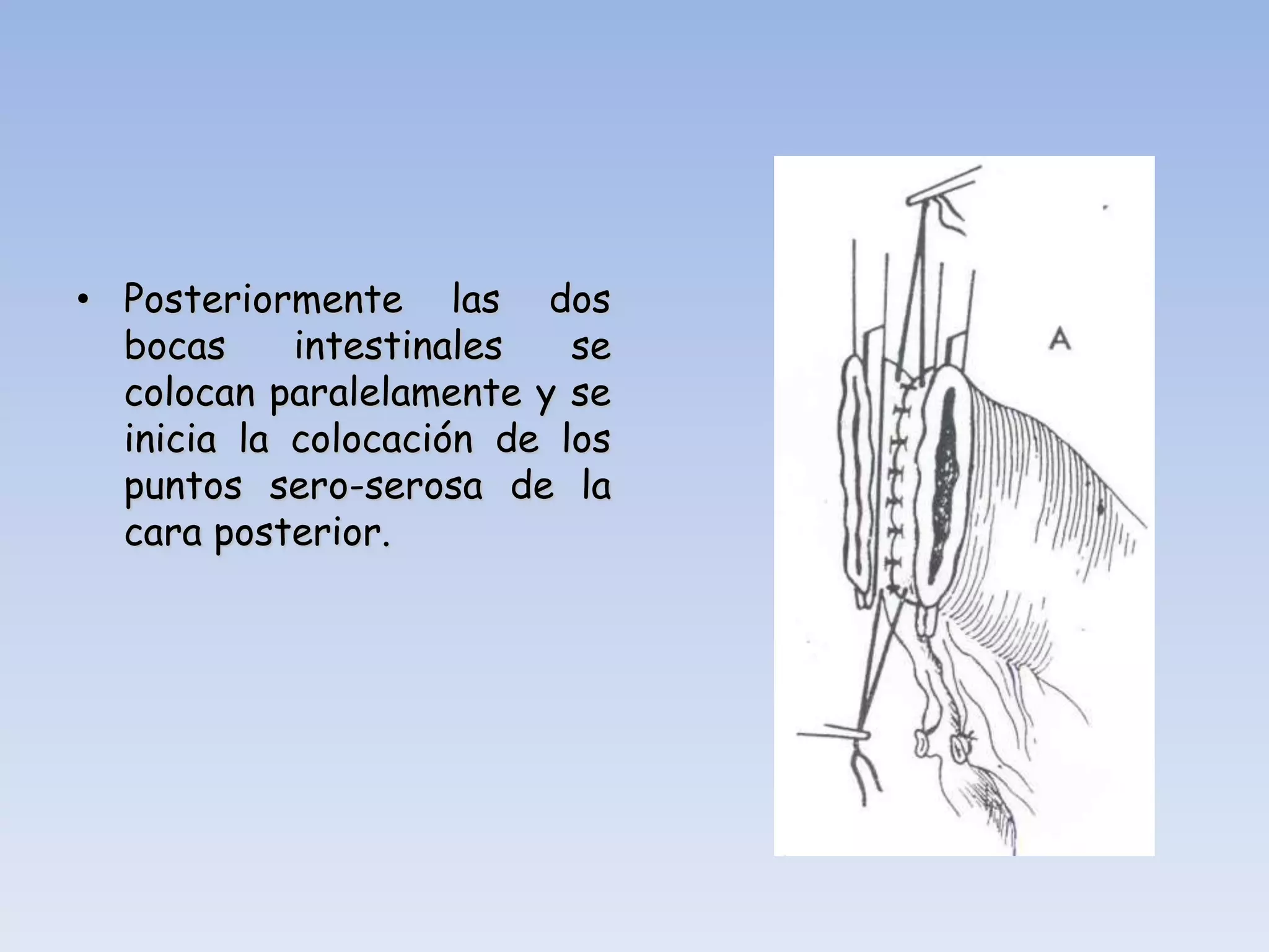 Generalidades de anastomosis intestinal | PPTX
