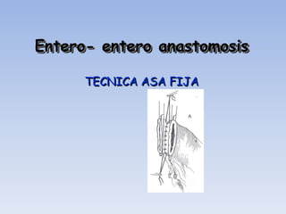 Generalidades de anastomosis intestinal | PPTX