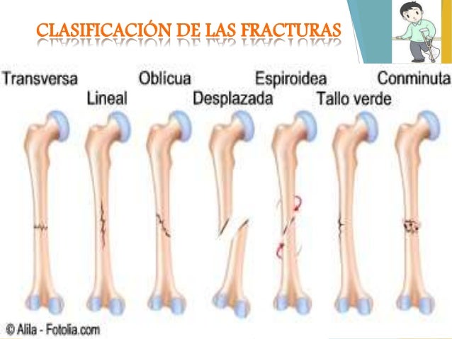 Generalidades de fracturas