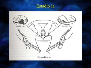 Generalidades del cancer cervico uterino | PPT