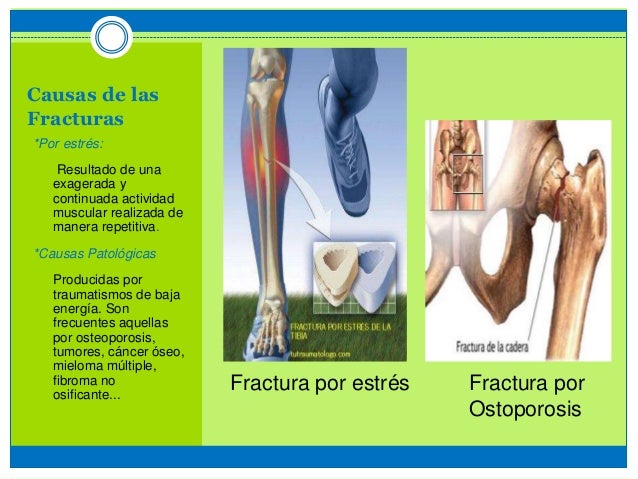 Generalidades sobre fracturas