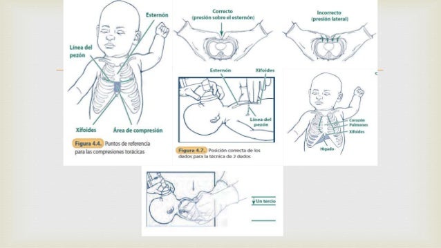 Reanimación cardiopulmonar neonatal