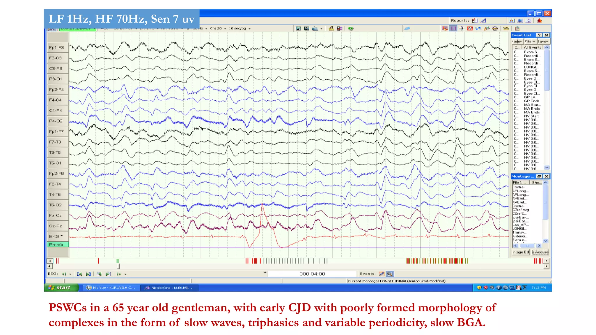 Generalised periodic epileptiform discharges | PPTX