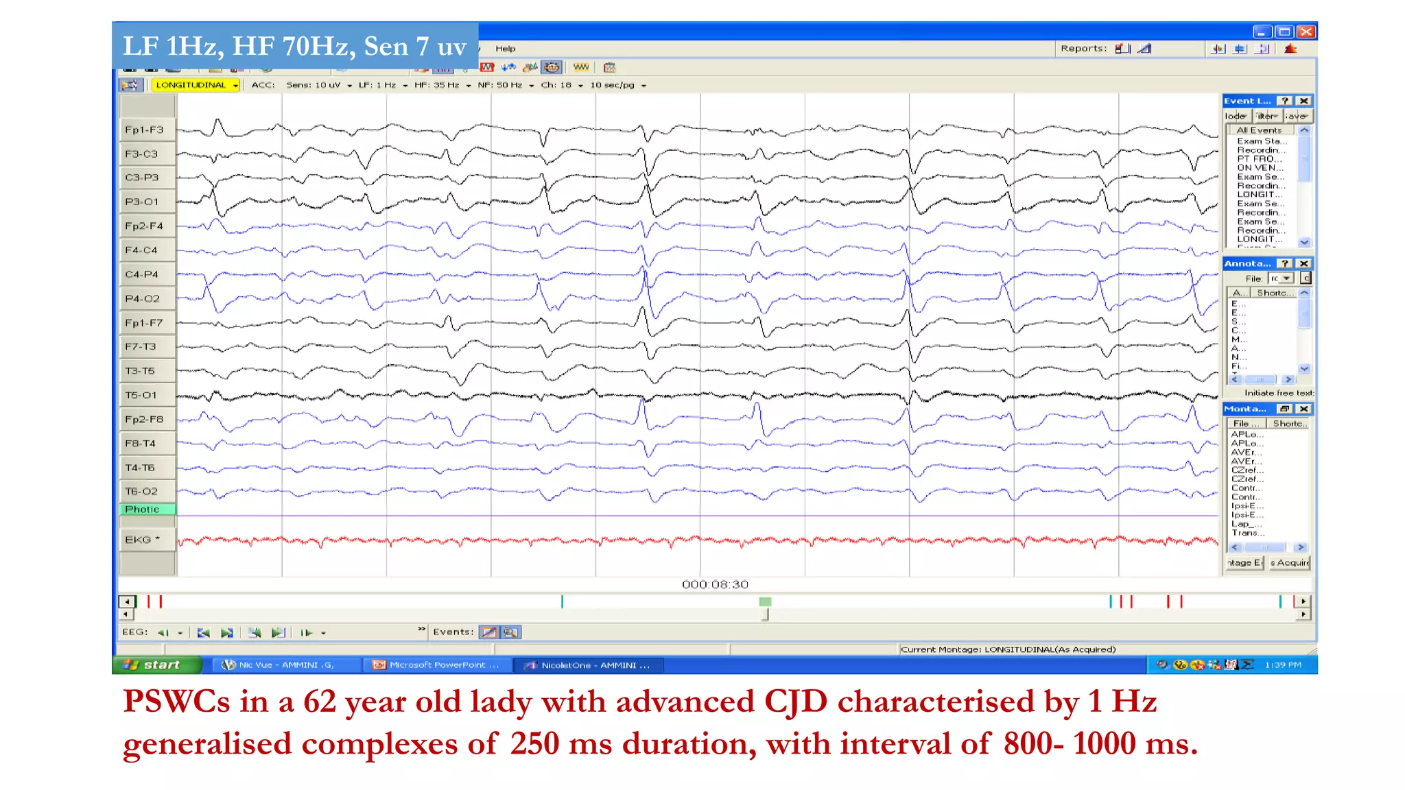 Generalised periodic epileptiform discharges | PPTX