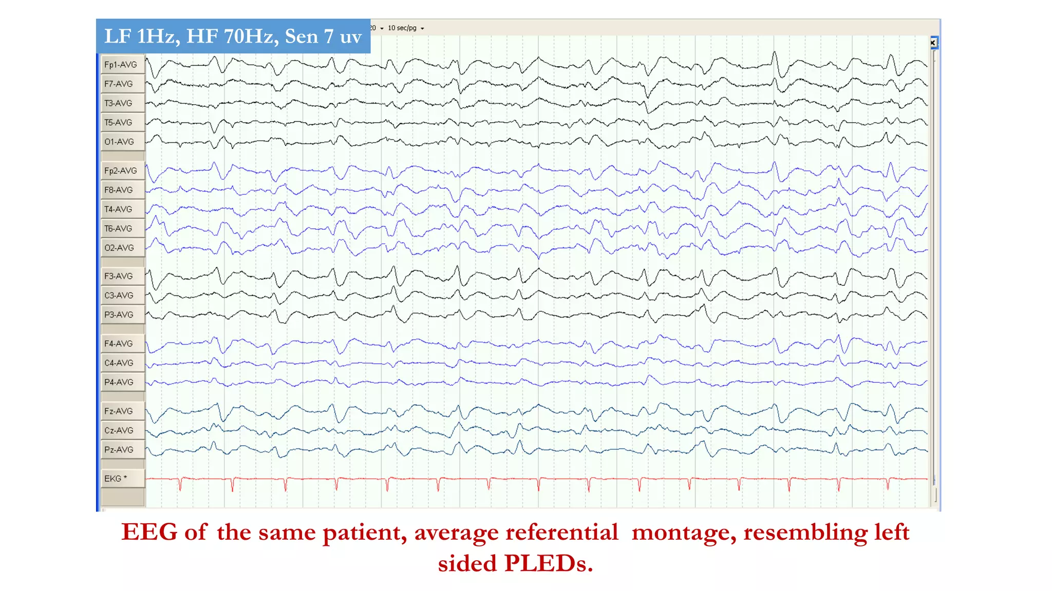 Generalised periodic epileptiform discharges | PPTX