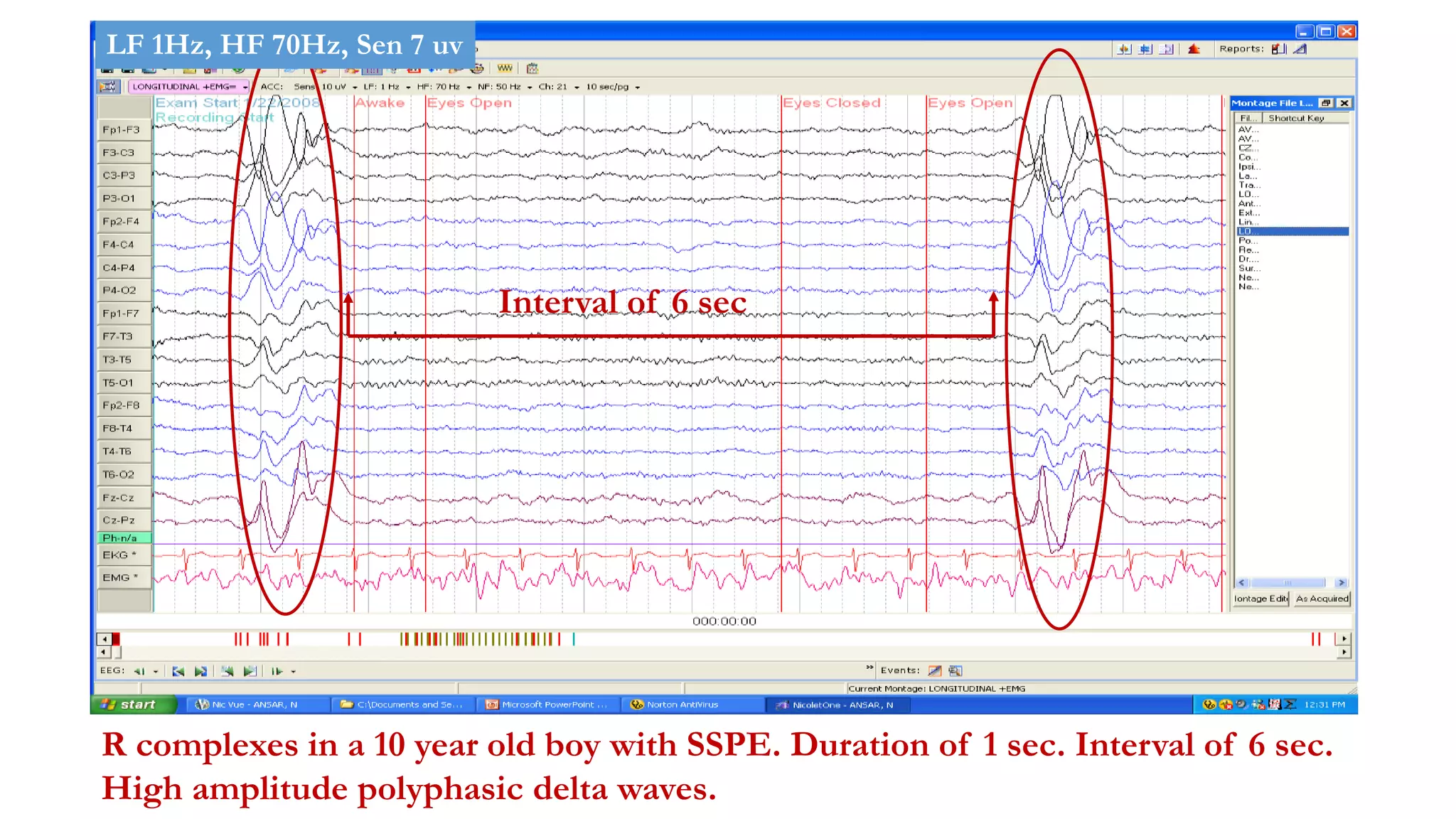 Generalised periodic epileptiform discharges | PPTX