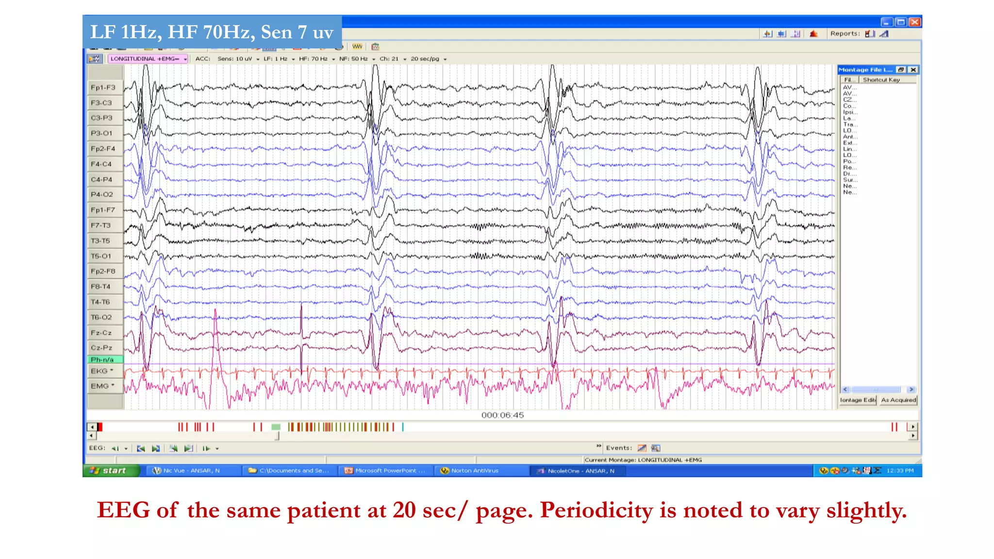 Generalised periodic epileptiform discharges | PPTX